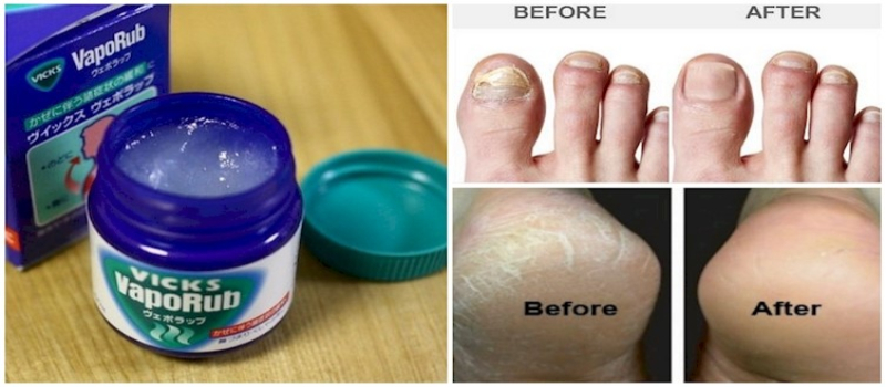 Vicks for toenail fungus store